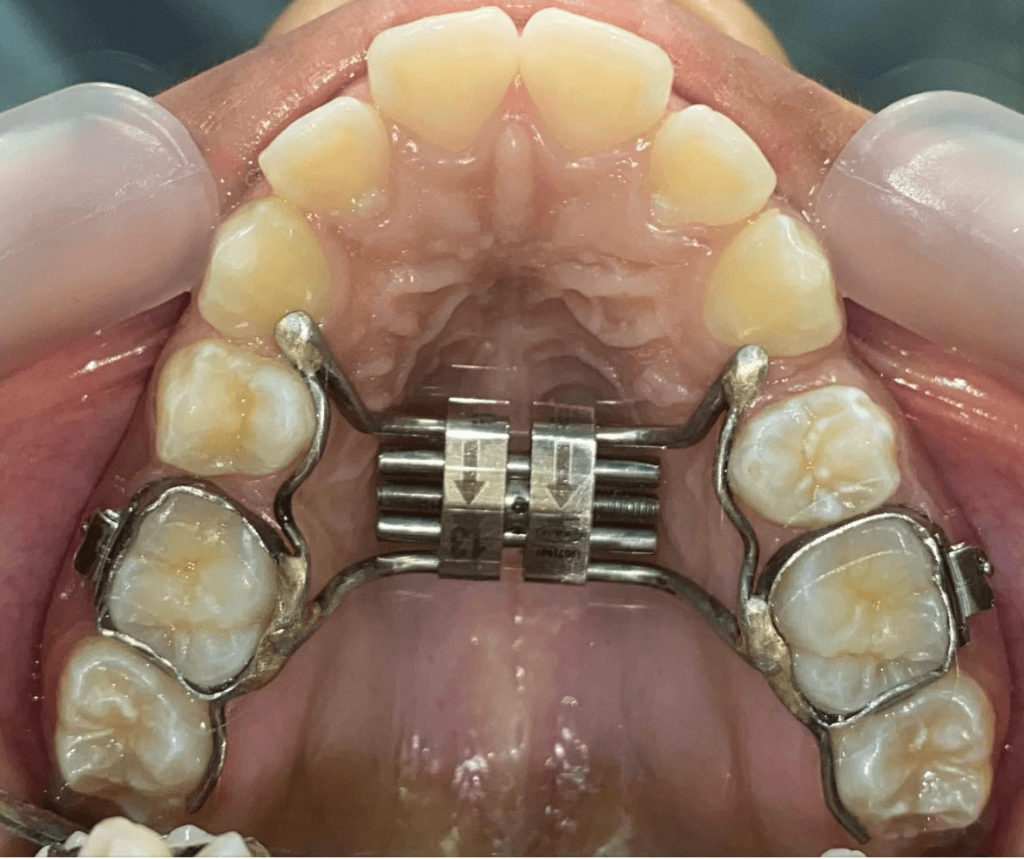 Expansor palatino: qué es, para qué sirve y cuándo se recomienda