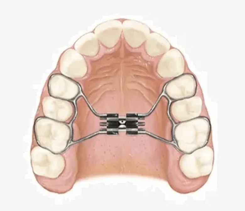 Expansor palatino: qué es, para qué sirve y cuándo se recomienda