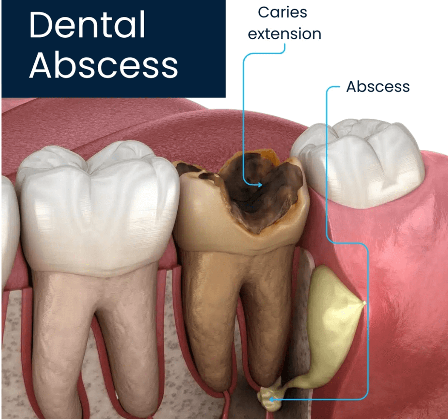 Drenaje de absceso dental: cuándo es necesario y cómo alivia