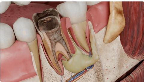 Drenaje de absceso dental: cuándo es necesario y cómo alivia